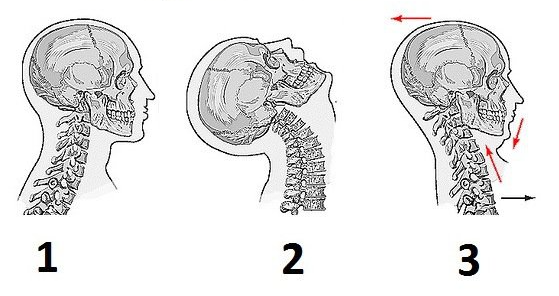 Síndrome de Latigazo Cervical