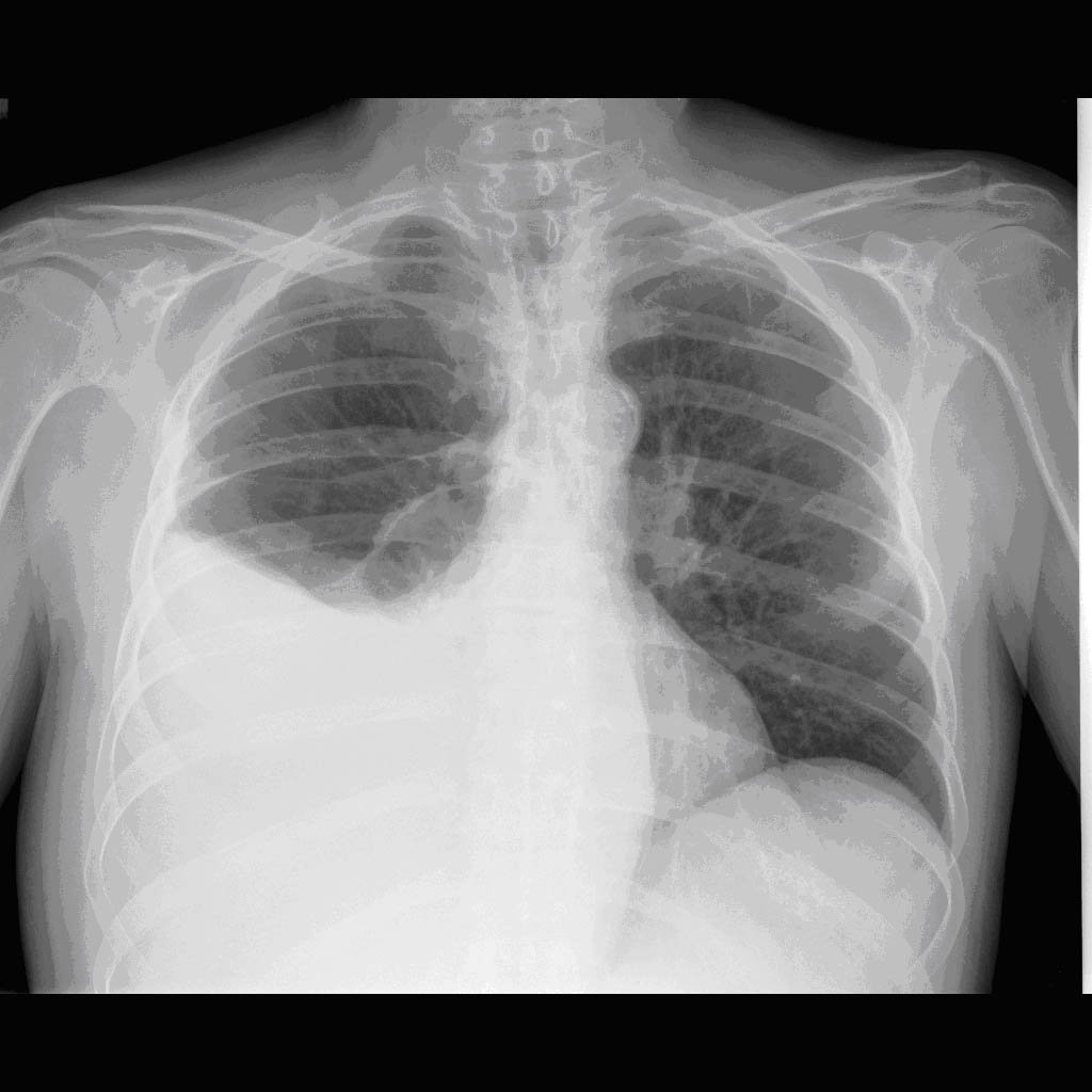 Chirurgie thoracique Dijon Besançon - cancer du poumon