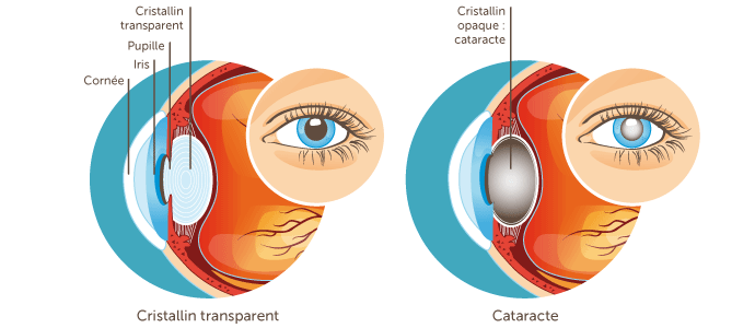 Pathologies du cristallin | Pole Ophtalmologique Yvelines 78