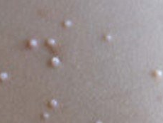 Molluscum Contagiosum