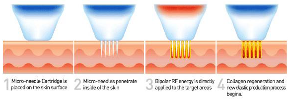 Radio Frequency Microneedling