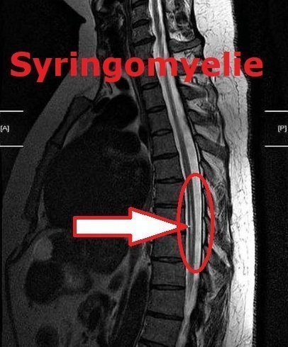 Hintergründe, Syringomyelie, Chiari Malformation, Diagnosen, Fotos
