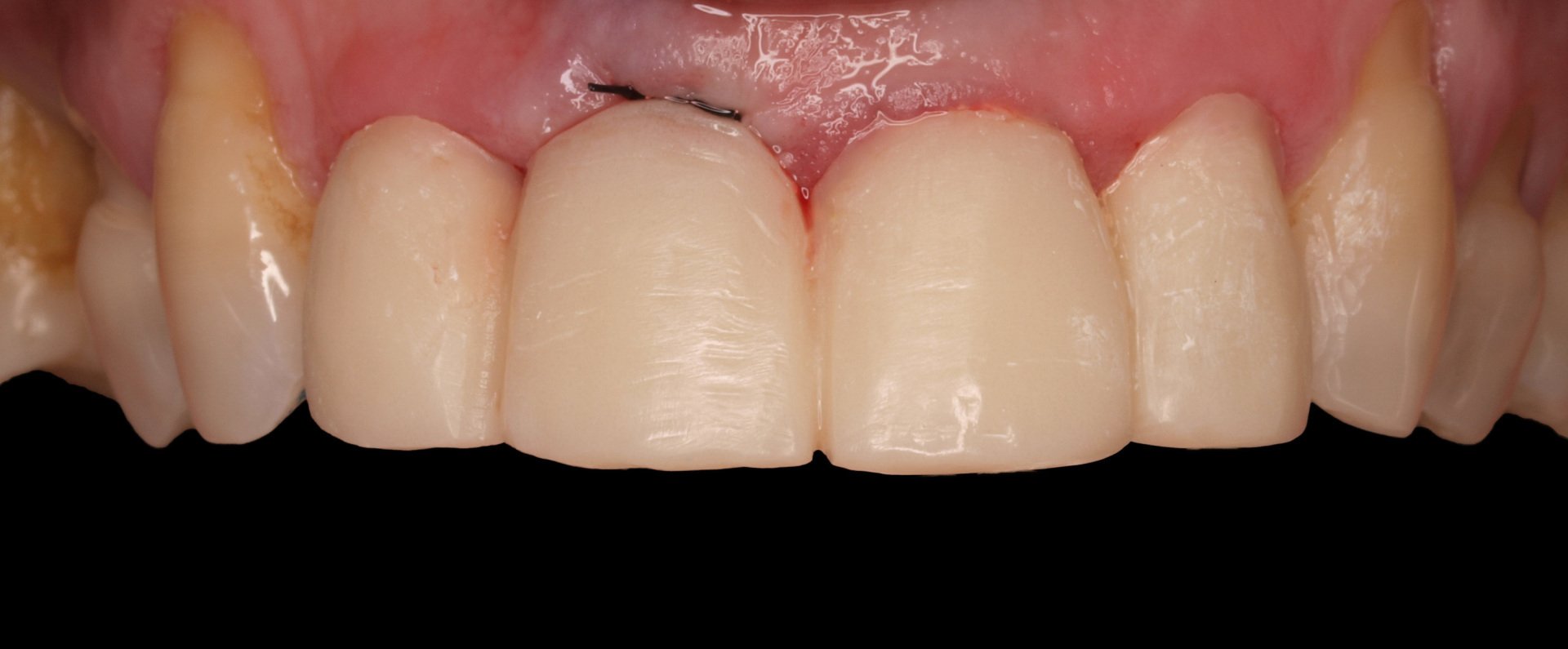 zirconio,monolitico,estratificado,disilicato,emax,cadcam