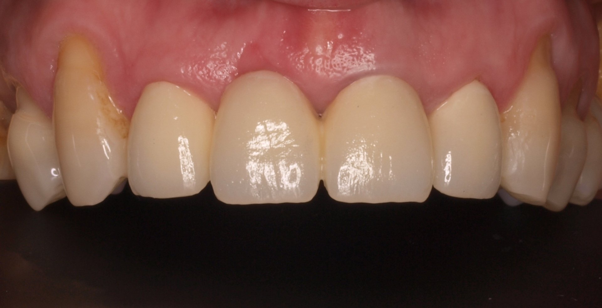 zirconio,monolitico,estratificado,disilicato,emax,cadcam