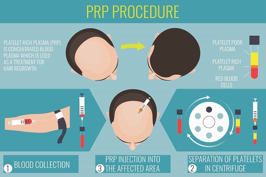 PRP for hair loss at the PRP Clinic in Leeds, West Yorkshire.