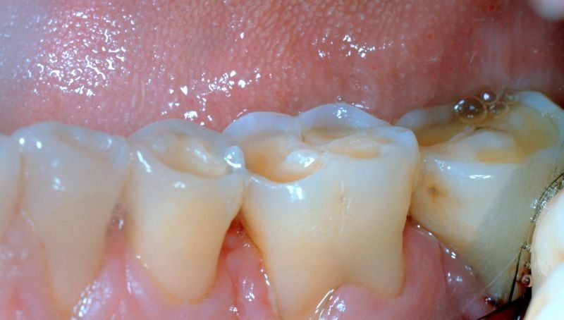 Apretar dientes-bruxismo ¿Qué debo saber?¿puedo perder mis dientes?