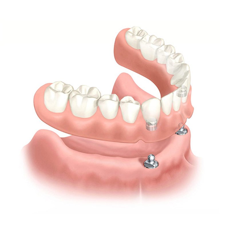Implantes dentales ¿Qué debo saber?. Clínica Cámara Granada y Jaén.