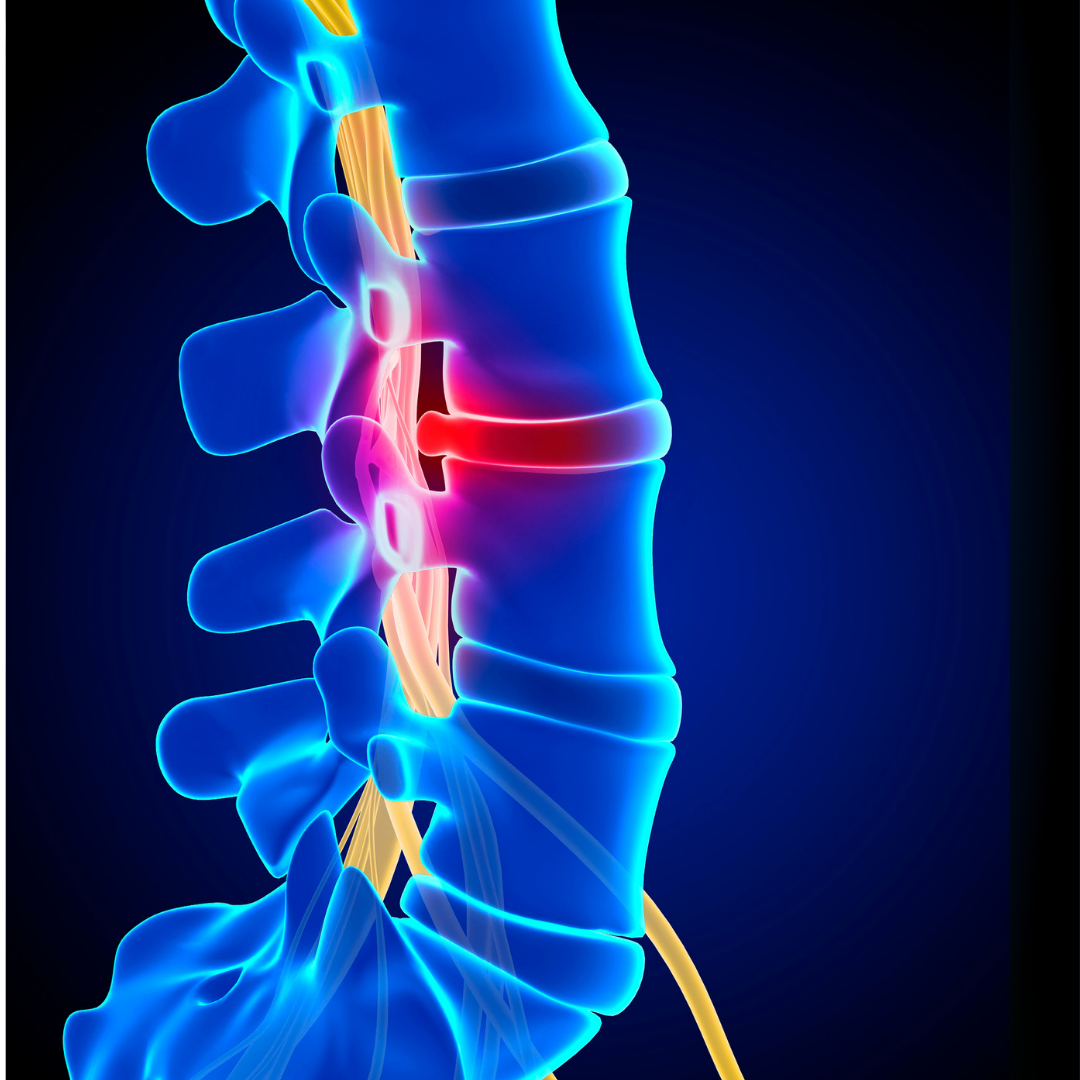 Sciatica. What is it and how can I get rid of it?