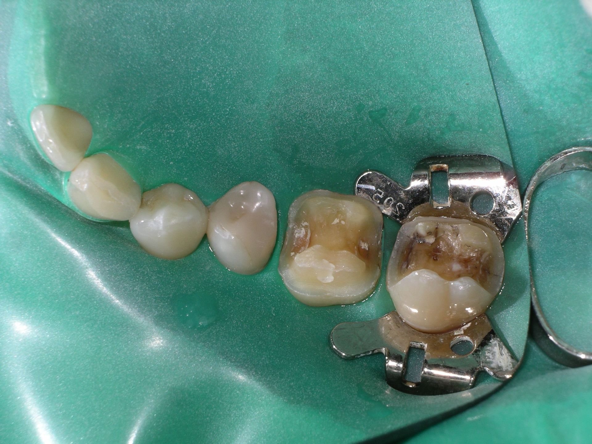 Kofferdam in der täglichen Anwendung