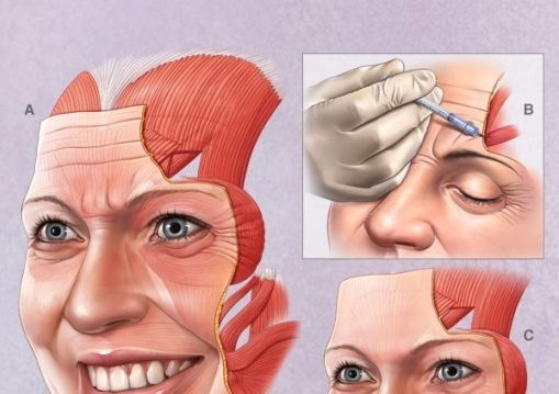 ¿Cómo funcionan las neurotoxinas? Botox, y en que músculos se aplican