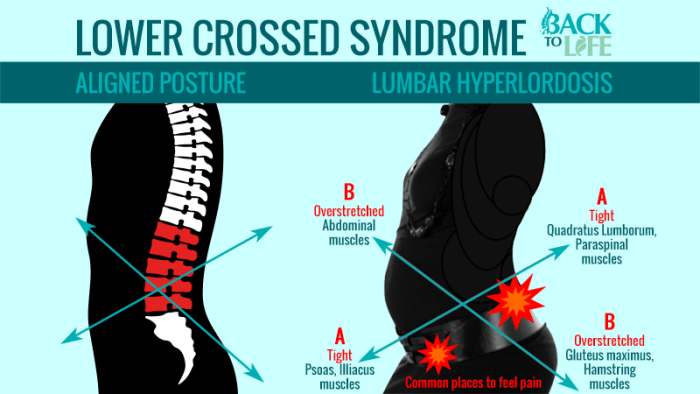 Lower Cross Syndrome