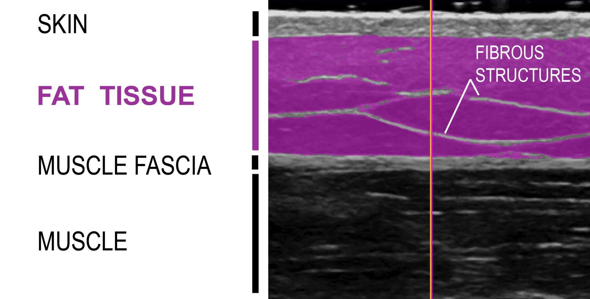 NISOS - BODY COMPOSITION ANALYSES, ULTRASOUND BODY FAT MEASURMENT (SAT ...