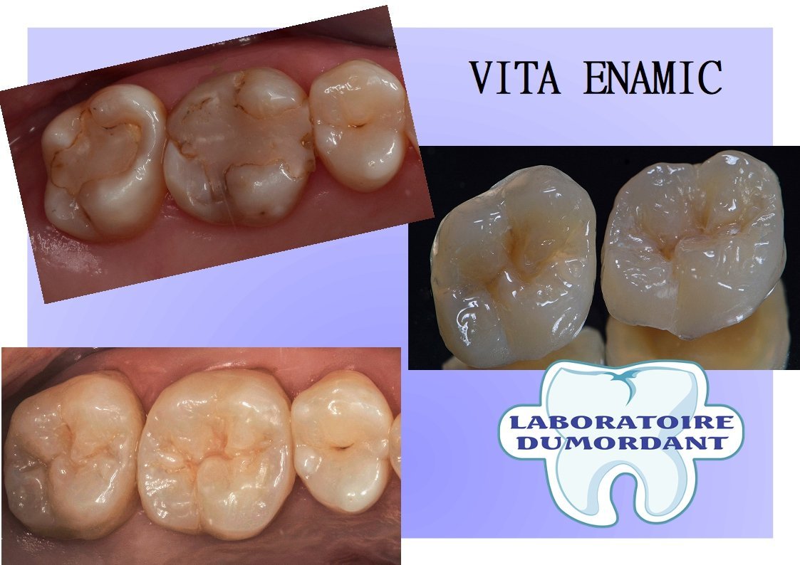 enamic , céramique hybride dentaire