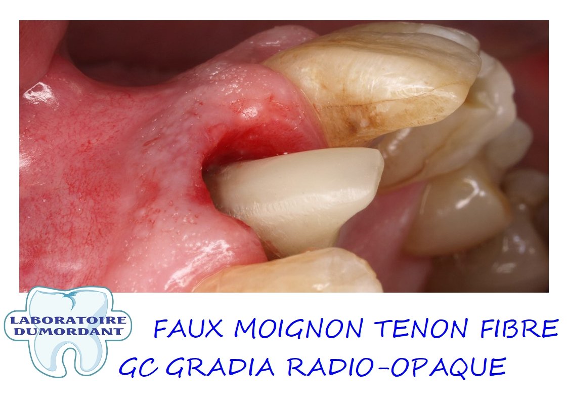 gc gradia , composite dentaire