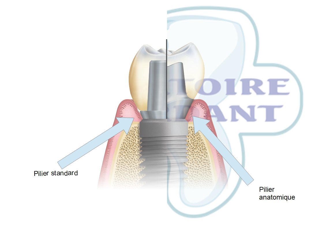 pilier implantaire
