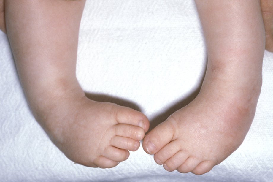 Vascular Ehlers-Danlos Syndrome - UK Registered Charity