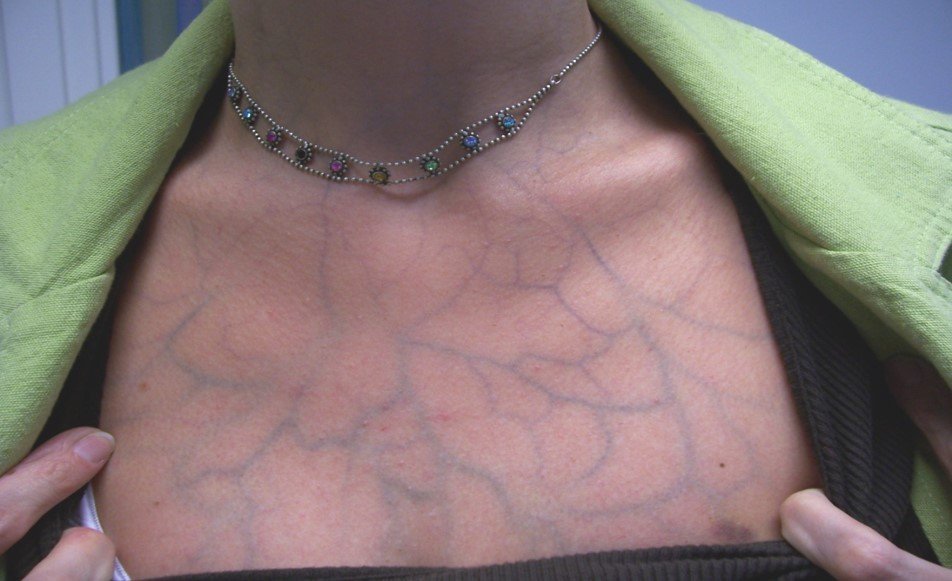 Vascular Ehlers-Danlos Syndrome - UK Registered Charity