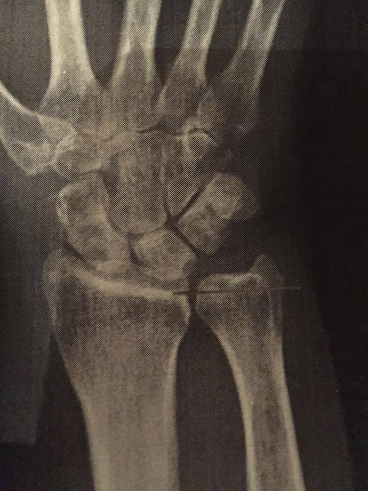 Lunatummalazie, Lunatumnekrose, Morbus Kienböck, Mondbeintod, Kienböcks ...