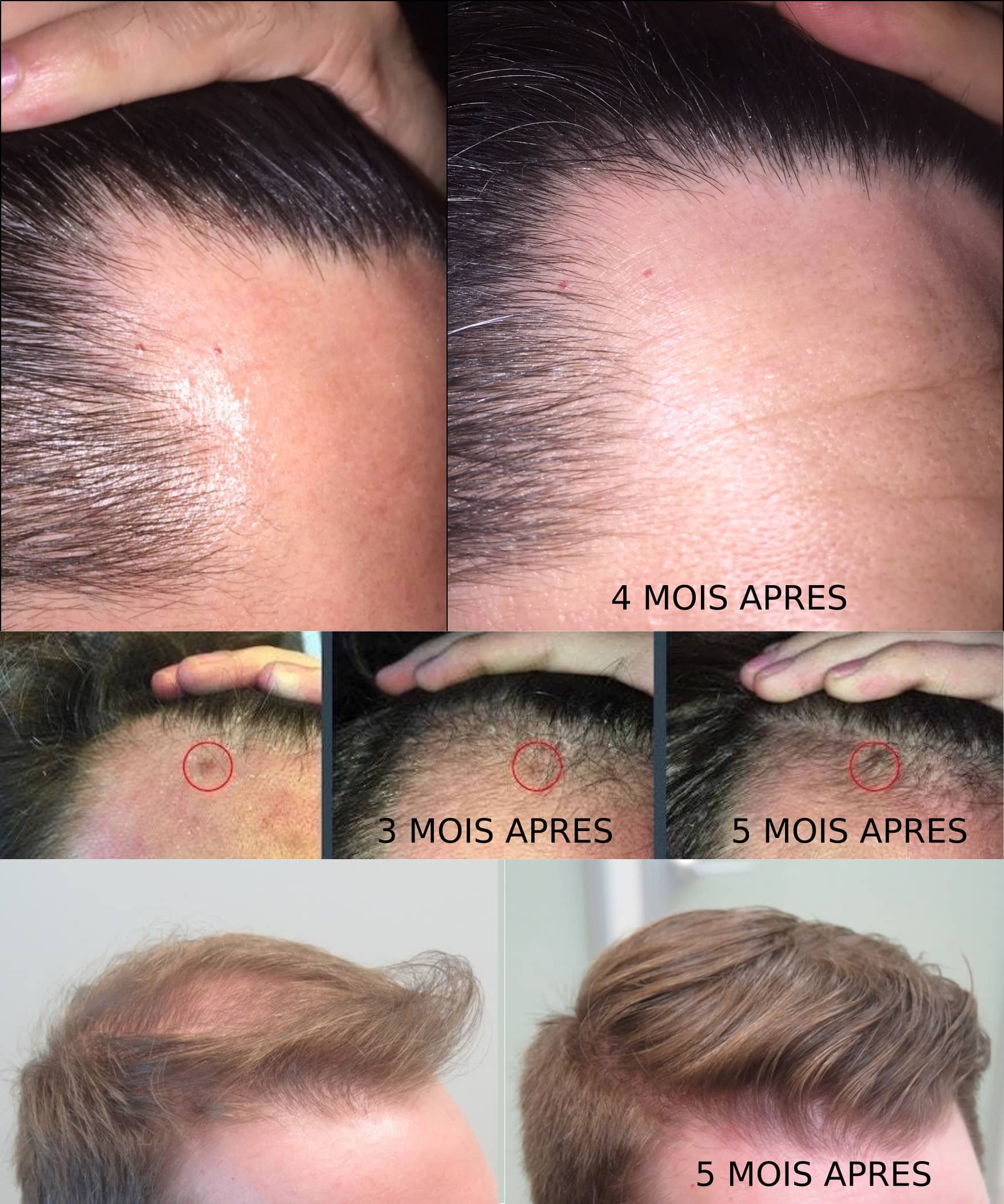 Microneedling Paris : découvrez notre soin anti calvitie