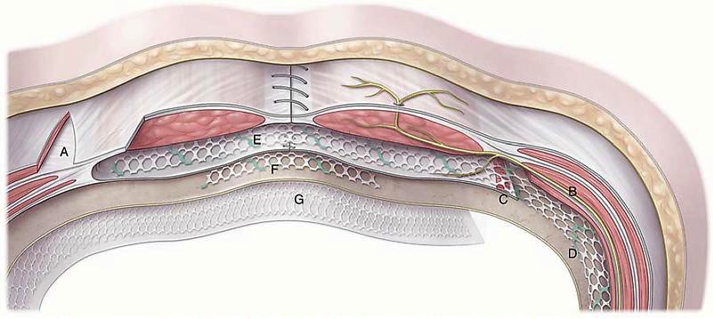 Dott. Francesco Saverio Mari - Chirurgia Laparocele