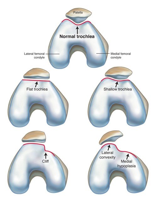 Patellar Instability, Physiohterapy, Bony Surgery | Personalised knee ...