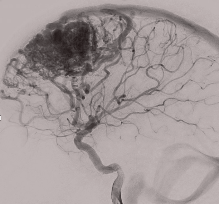 Neurocirugía Hospital Universitario Rio Hortega Valladolid