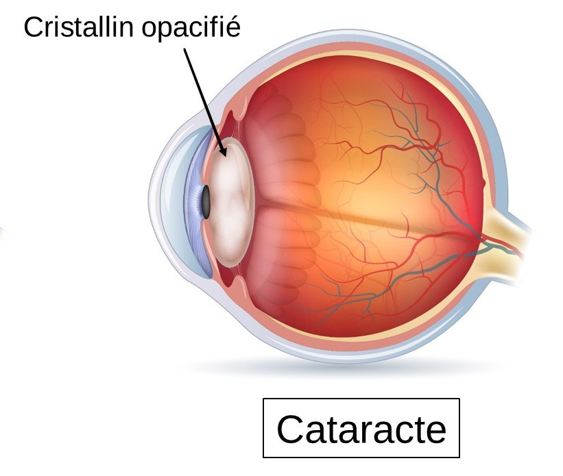 Rendez-vous rapide en ophtalmologie - Pole Ophtalmo Melun