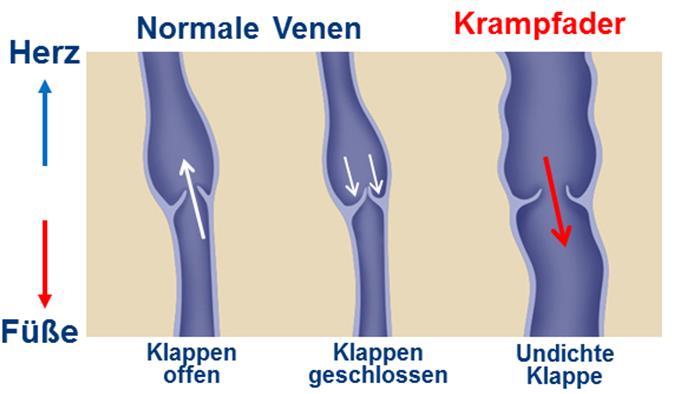 Krampfadern behandeln in Heidelberg. Venen und Besenreiser Ursachen