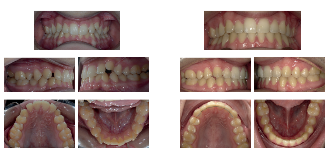 Triamond™ WedgeWise-System - einfach, sicher, planbar