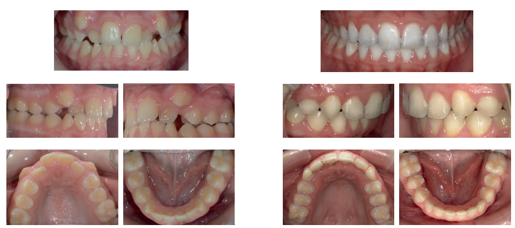Triamond™ WedgeWise-System - einfach, sicher, planbar