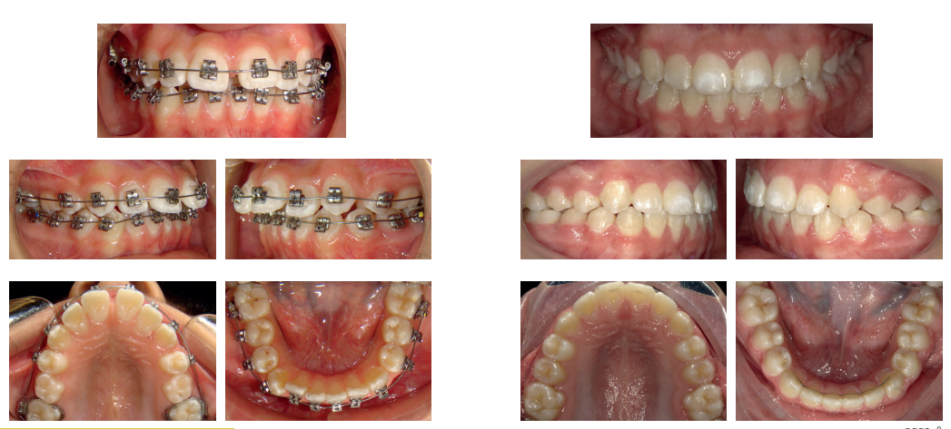 Triamond™ WedgeWise-System - einfach, sicher, planbar
