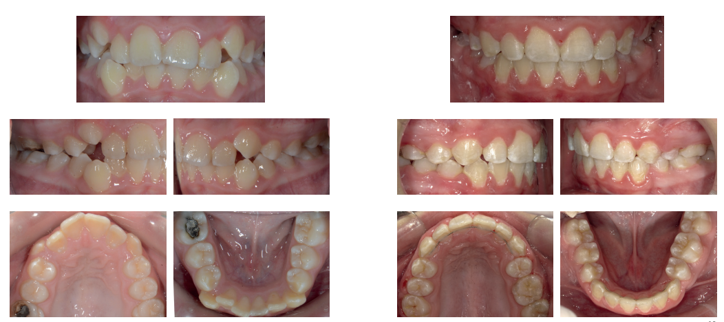 Triamond™ WedgeWise-System - einfach, sicher, planbar