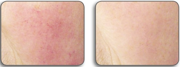 Couperose-Rosacea - Reducing