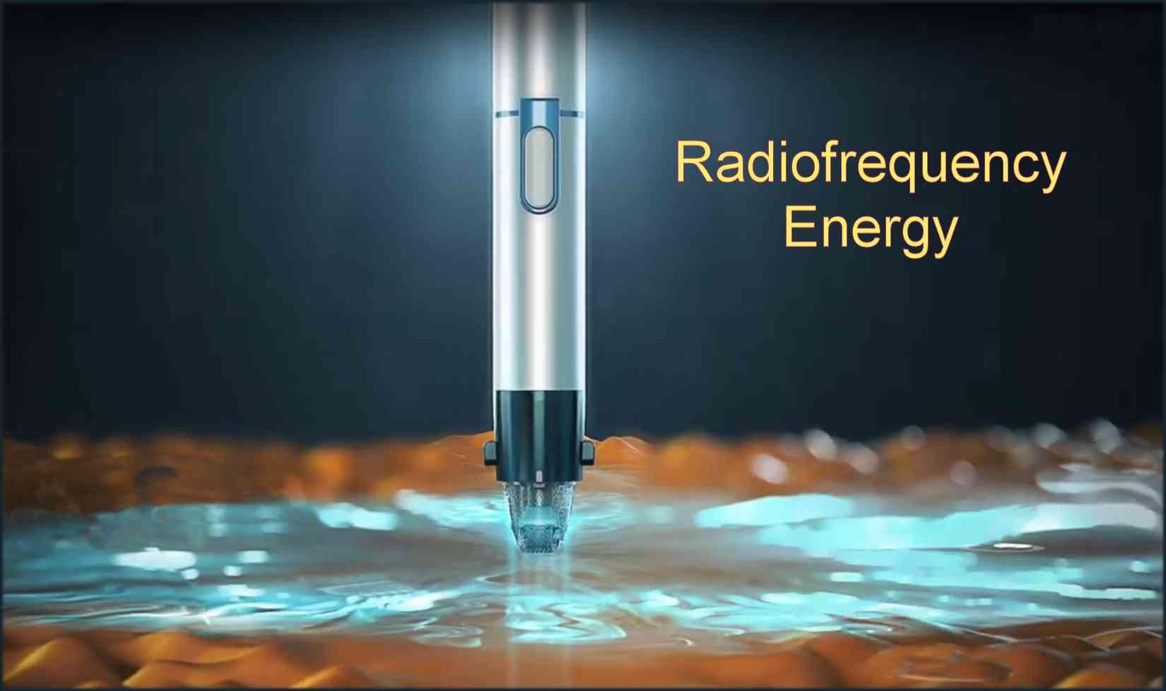 Hyperhidrosis Treatment with Radiofrequency