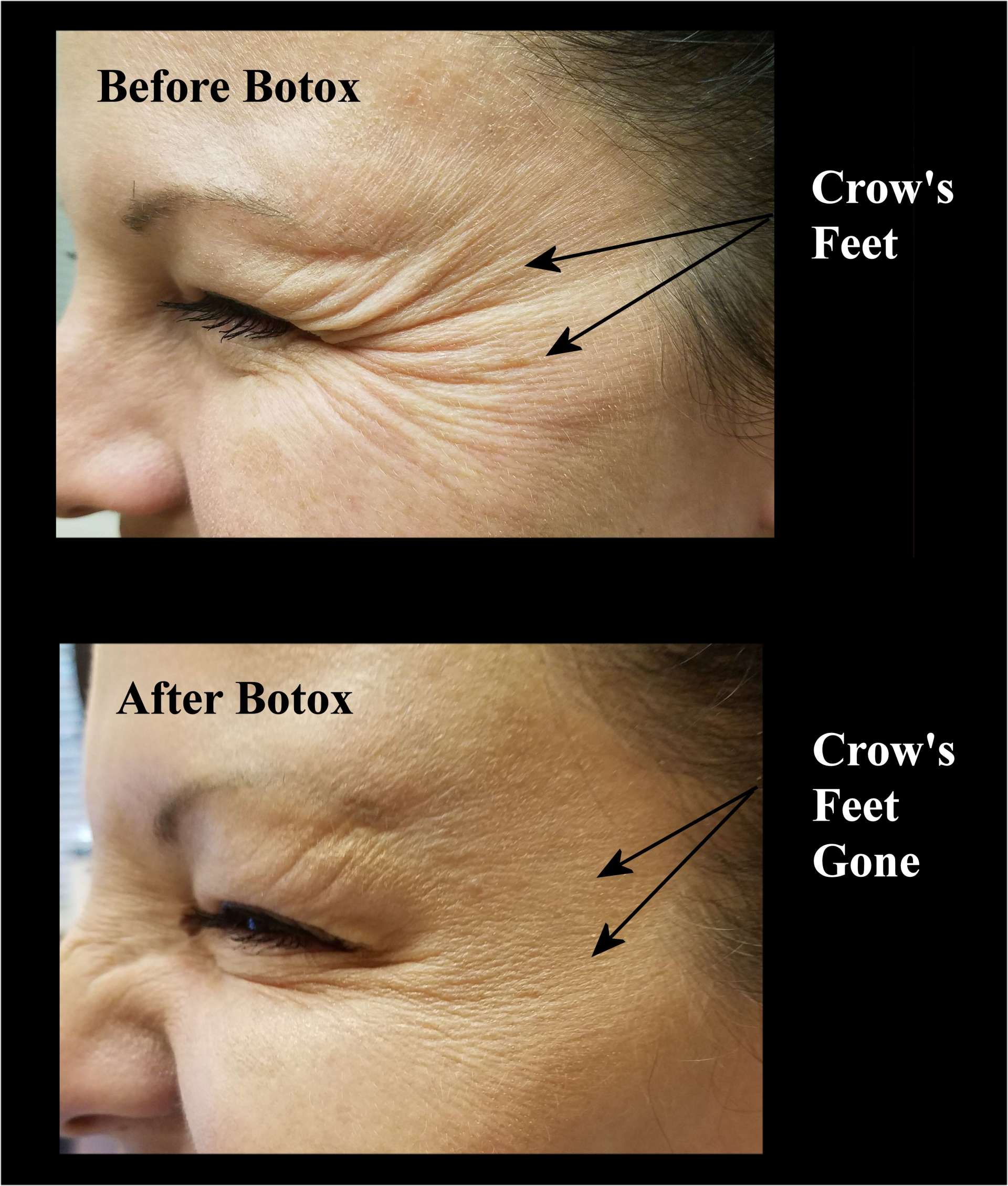 Botox & Dermal Fillers - MFM Laser Center