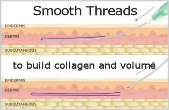 PDO Thread Lift - Results Matter