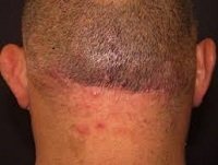 Folliculitis Itchy Scalp Condition - Scalp Problems - Trichosynergy ...