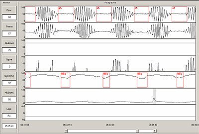 Cheyne Stokes Atmung: Lungenarztpraxis DOC