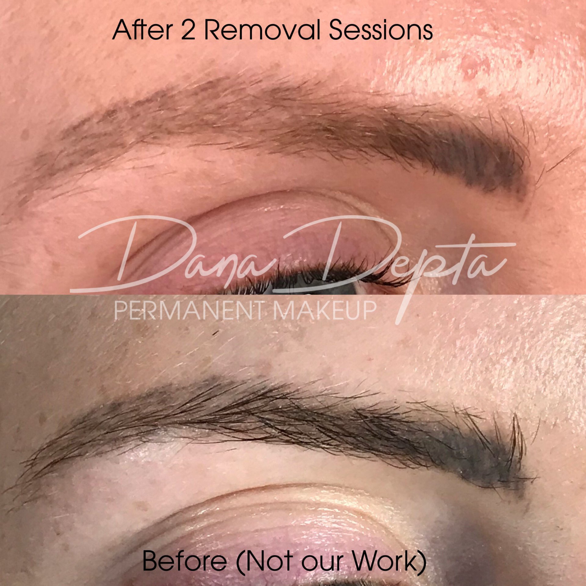 Saline Removal Photos | Dana Depta Permanent Makeup